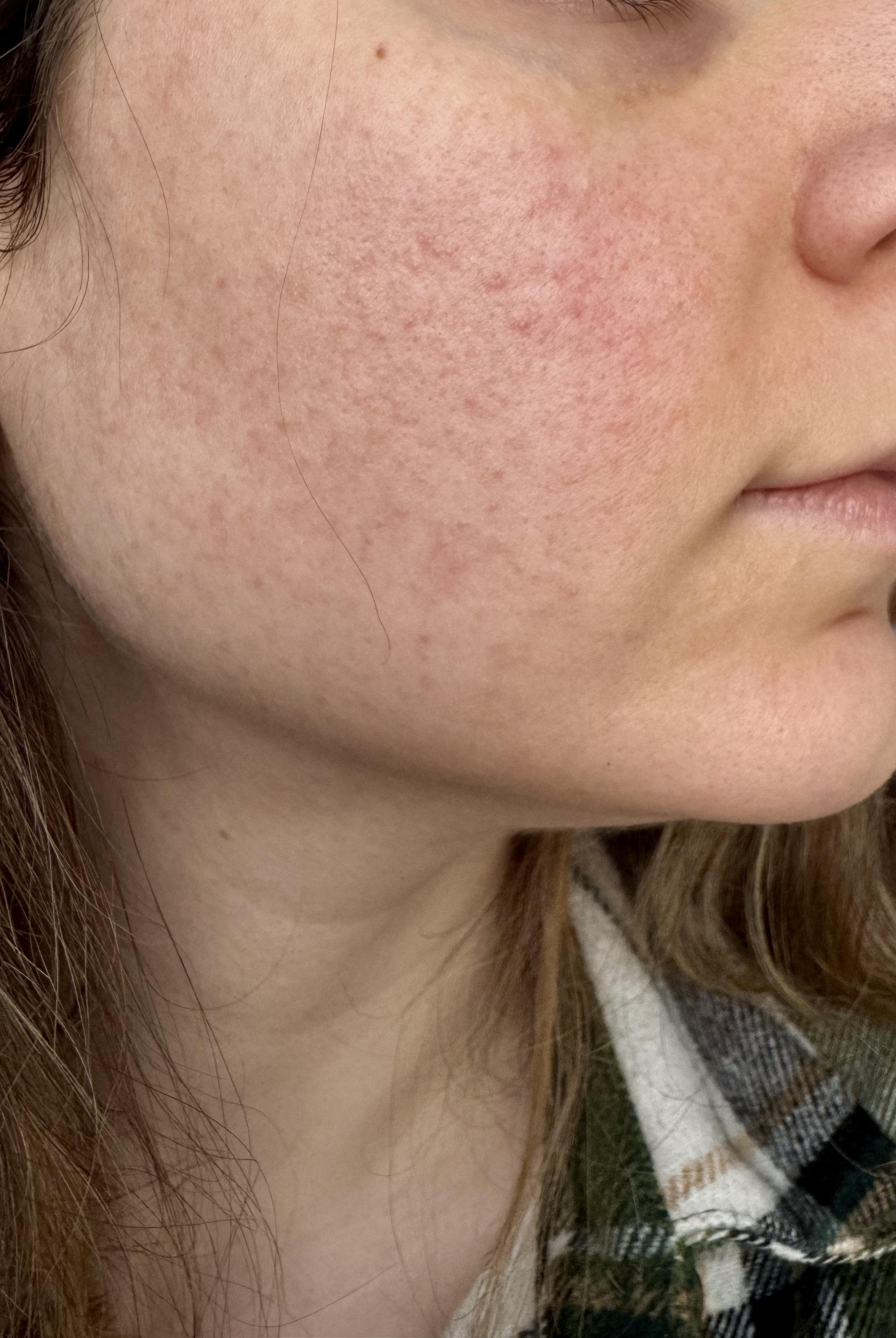 Post-Chemo; Barrier Damaged Skin Is Not “Sensitive” — It’s Protective!